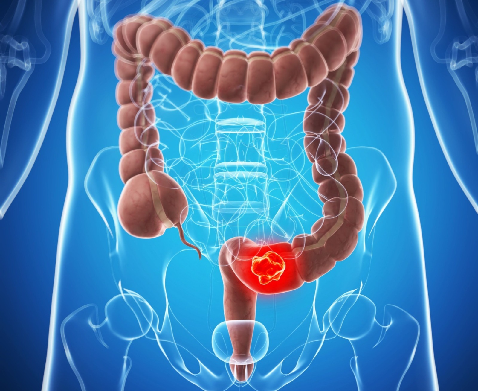 Brasil terá diretriz inédita para triagem precoce do câncer de cólon e reto